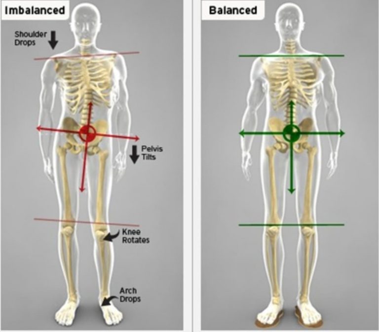 5 Things To Know About Uneven Hips and Abnormal Pelvic Tilts - Balanced ...