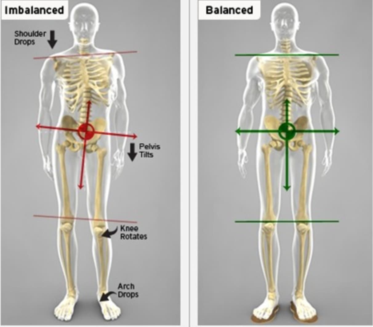 5 Things To Know About Uneven Hips and Abnormal Pelvic Tilts - Balanced ...