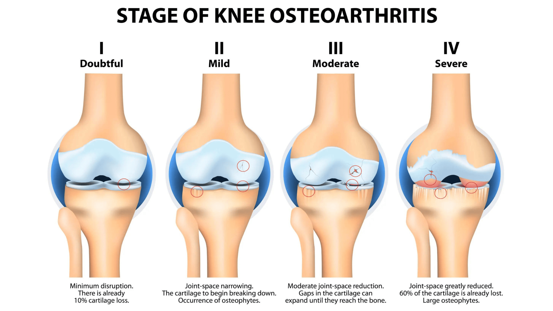Joint Pain: Causes, Relief, and Treatment - Balanced Physical Therapy